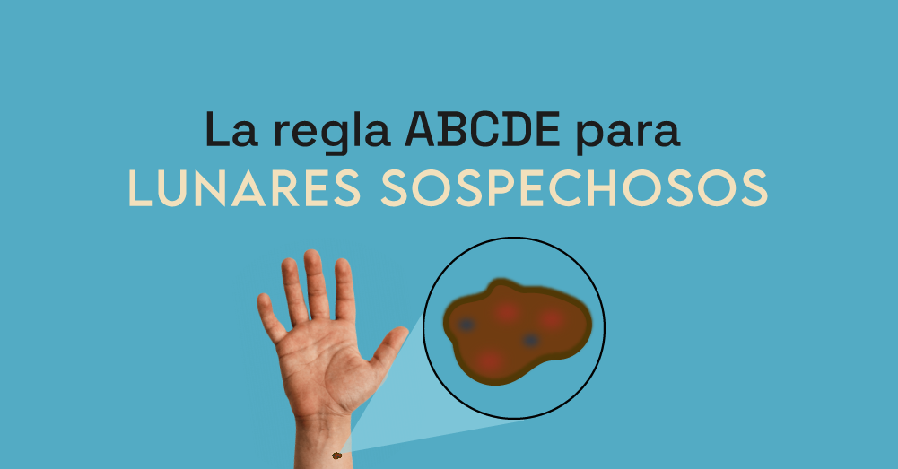 La regla ABCDE para lunares sospechosos